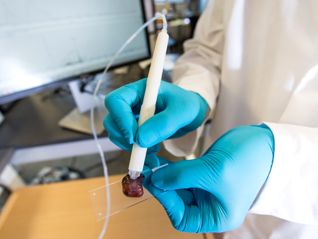 Pen detects cancer in 10 seconds - Technology - Business Recorder
